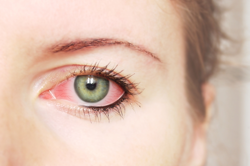 Allergies and What it Might Mean For Your Eyes | Clear Advantage