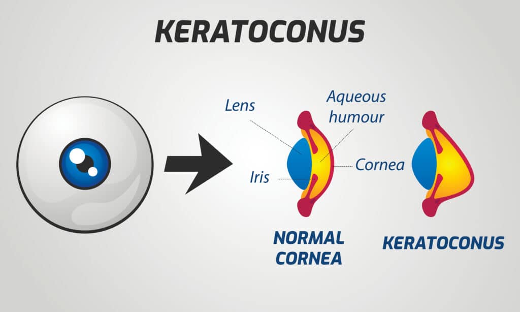 What is Keratoconus? | Clear Advantage