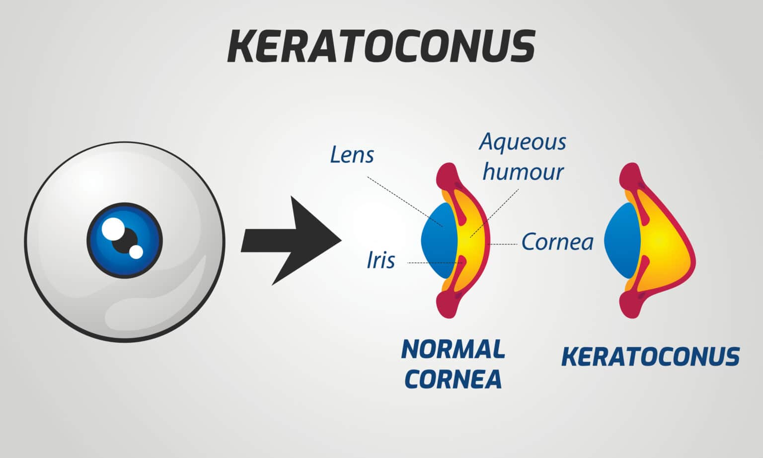 What is Keratoconus? | Clear Advantage