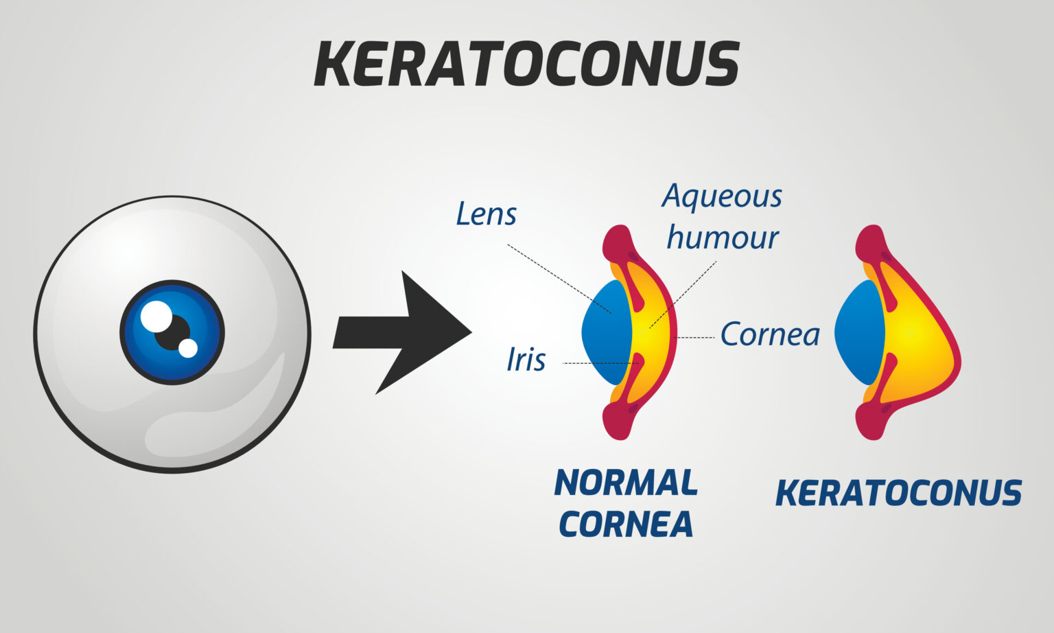 Who is Most Likely to Develop Keratoconus? | Clear Advantage