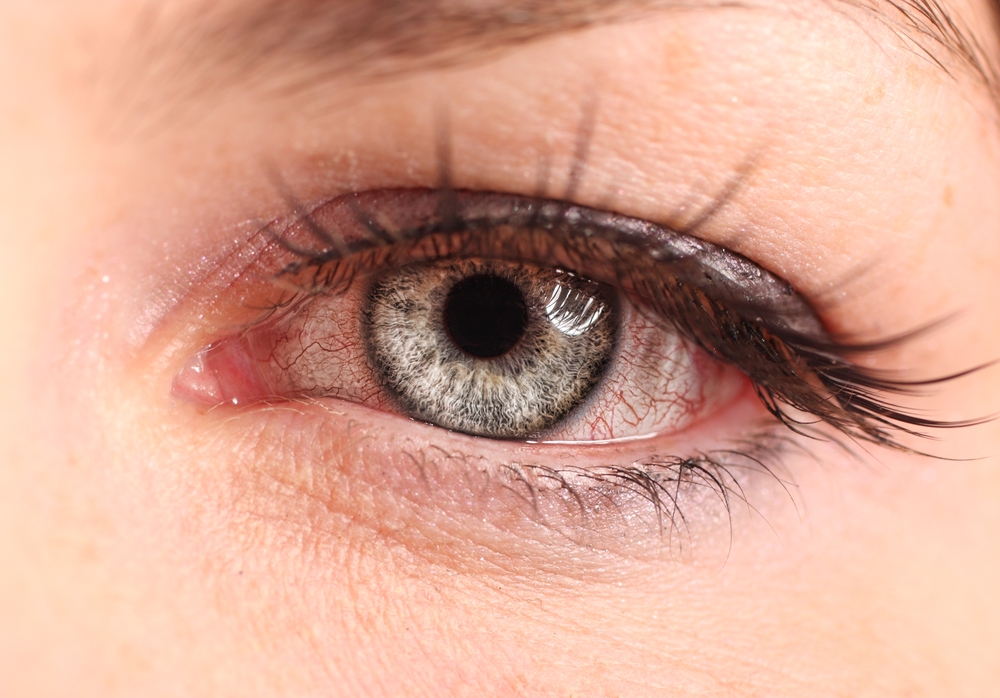 Everything You Need To Know About Pink Eye | Clear Advantage Laser